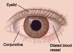 What is conjunctivitis? | Homework.Study.com