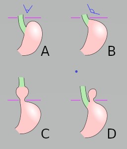 Provide a visual (if possible) of Hiatal Hernia. How will it help ...