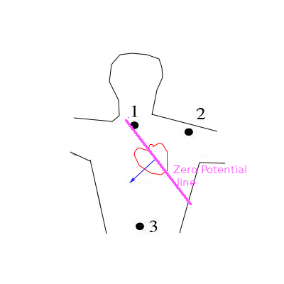 The dipole moment of the heart is shown at a particular instant in the ...