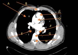 Identify the structures on this axial section of the thorax at the ...
