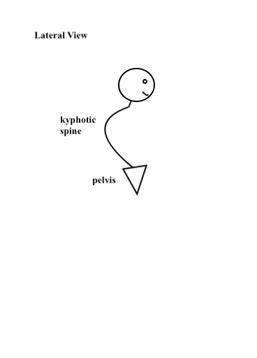 Diagram a kyphosis spinal curvature. Use posterior or lateral views as ...