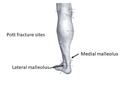 Fracture of the distal end of tibia, fibula, or both is more likely ...