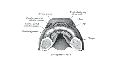 How does a cleft palate form? What problem could result from a cleft ...