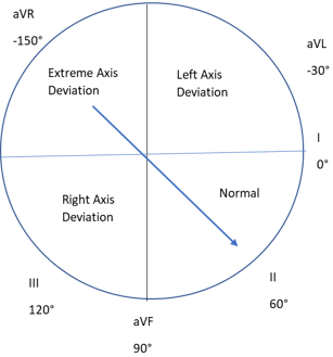 What accounts for the difference in appearance between lead 2 and lead ...
