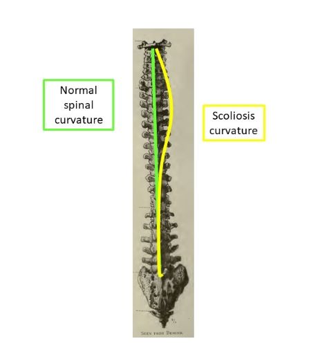 Diagram a scoliosis spinal curvature. Use posterior or lateral views as ...