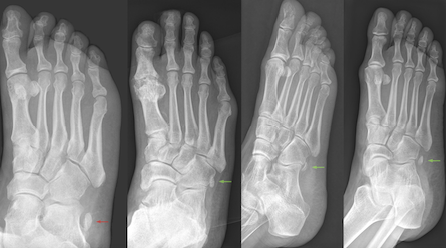 What is the name for the bones formed within tendons under condition of ...