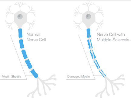 Damaged Myelin Sheath