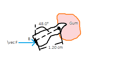 A dental bracket exerts a horizontal force of 68.5 N on a tooth at ...